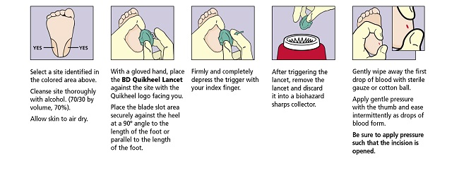 Sterile Single Use Safety Blood Lancet for Heel Stick on Infants