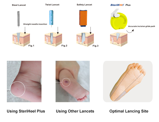 Sterile SteriHeel Plus Pediatric Lancet for Heel Incision, Box of 50