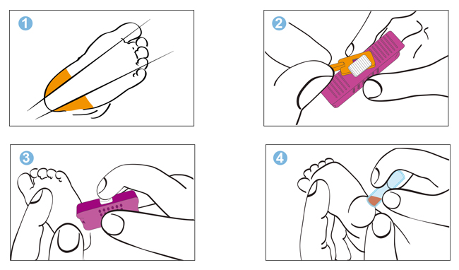 Sterile Newborn Heel Incision Device with Micro Surgical Blade